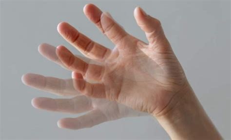 El Parkinson enfermedad neurodegenerativa Qué sabemos de esta enfermedad