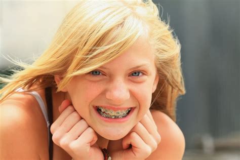 Diamond Braces Different Types Of Braces And What They Work Best On