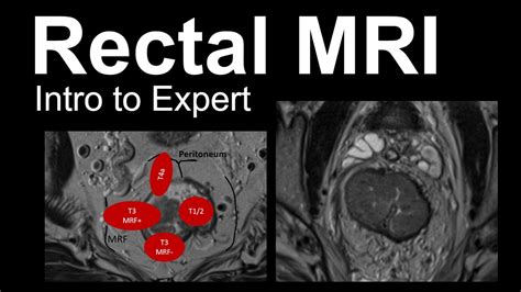 Rectal Mri Intro To Expert Rectal Cancer Staging Youtube