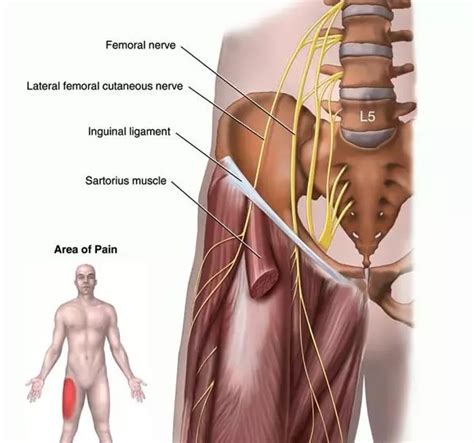 Meralgia Paresthetica Orchard Health Clinic Osteopathy