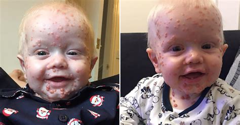 Forældrene troede at 4 årige Oscar havde skoldkopper måneder senere