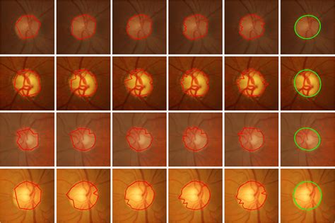 optic disc segmentation in drishti gs with different numbers of download scientific diagram