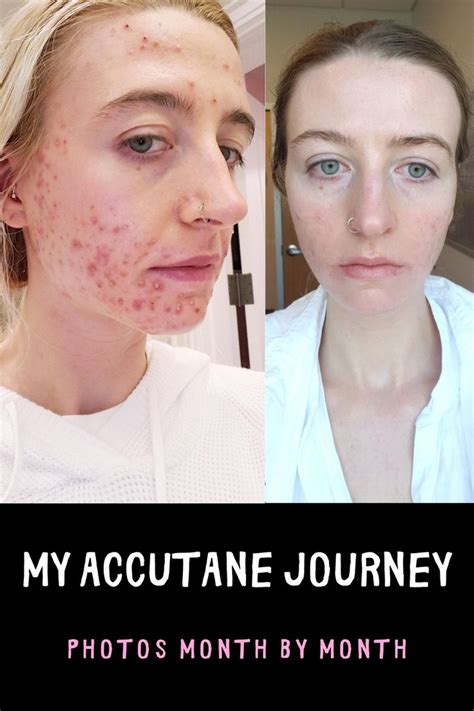 MY ACCUTANE JOURNEY I Before After Photos Of Acne Clear Skin Dry
