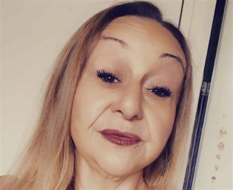 C Cile Ans Est Atteinte De Cutis Laxa Sa Peau Est Alors Tr S
