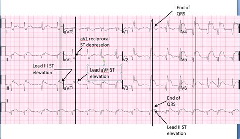 Dr Smith S Ecg Blog Subacute Anteroseptal Stemi With Persistent St