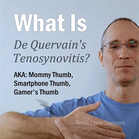 What Is De Quervains Tenosynovitis AKA Mommy Thumb Or Gamers