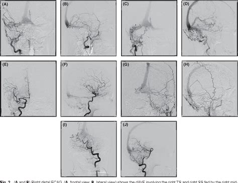 Figure 2 From A Case Of Transverse Sigmoid Sinus Dural Arteriovenous