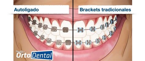Nuevos Brackets Damon Q2 en México OrtoDental Ortodoncista en