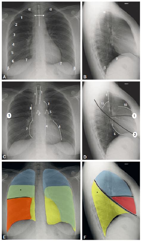 Pneumothorax Radiographie Pulmonaire