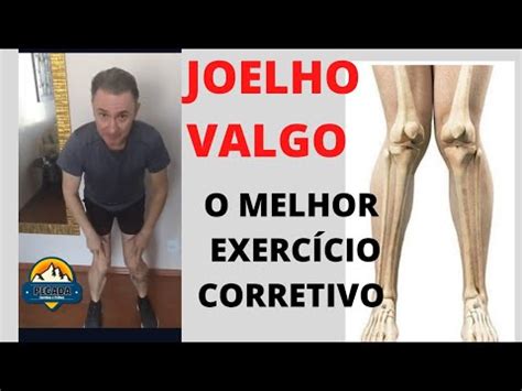 JOELHO VALGO EXERCICIOS CORRETIVOS PREVENÇÃO DE LESÃO DE LCA YouTube