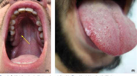 Figure 4 From Oral Transmission Of Sexually Transmissable Infections A Narrative Review