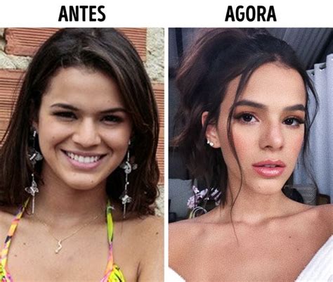 Confira o Antes e Depois das cirurgias plásticas de 15 famosas