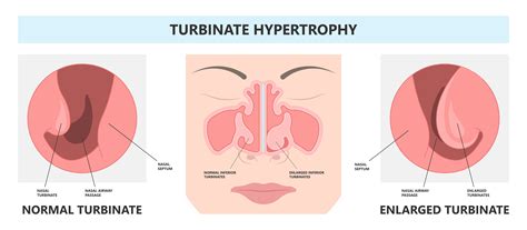 Septum And Turbinate Surgery
