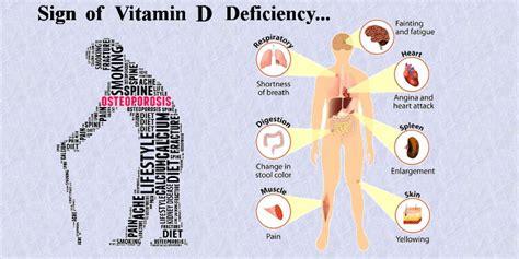 Vitamin D Deficiency Symptoms Causes Ck Birla Hospital Off