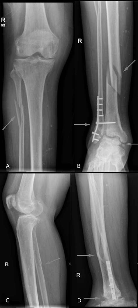 Cureus Simultaneous Surgical Management Of Acute Tibial Shaft