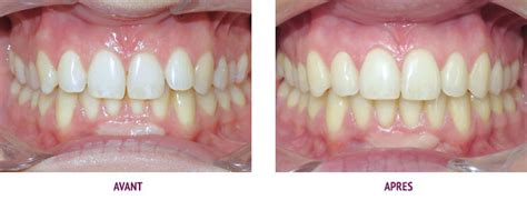 Orthodontie Paris Traitement Cas Avant Apr S