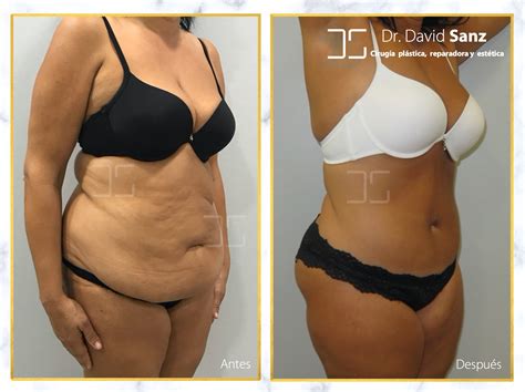 9 Abdominoplastia Y Lipoescultura UsamaShantelle