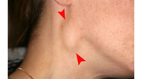 Disease Lympadenopathy Colli AI Care