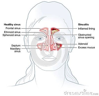 Healthy Sinus And Sinusitis Medical Illustration Labeled Royalty Free