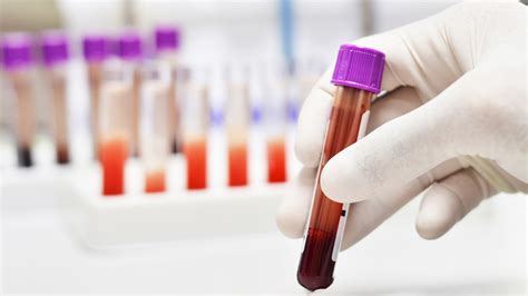 Desarrollan Un M Todo Para Detectar La Esclerosis M Ltiple En Muestras