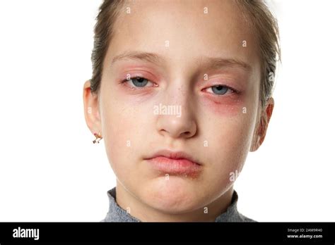 Allergic Reaction Skin Rash Close View Portrait Of A Girls Face Redness And Inflammation Of