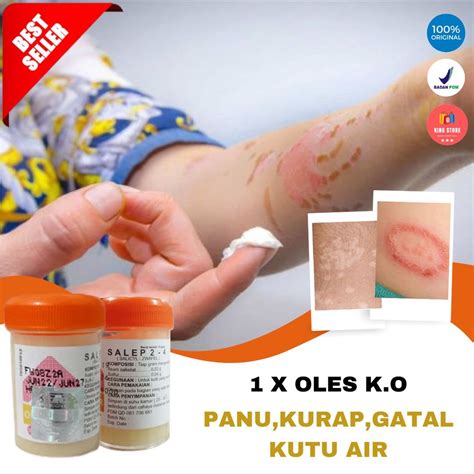 Jual Obat Panu Paling Ampuh 100 Salep Zwafel Gatal Original Sulfur