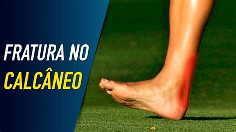 FRATURA do CALCANHAR TRATAMENTO e EVOLUÇÃO Clínica de Fisioterapia Dr