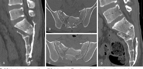 Figure 3 From The Treatment Of Transverse Fracture Of The Upper Sacrum