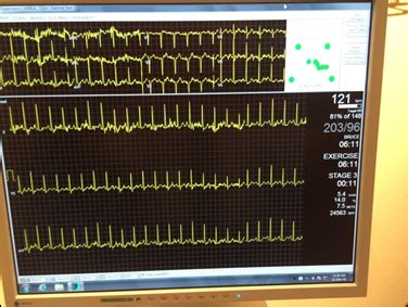 Hour Holter Monitoring Peter Yan Cardiology Clinic