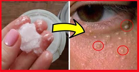 Que son esas bolitas blancas que aparecen alrededor de los ojos y cómo