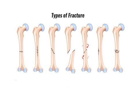 Fracture Types Diagram Quizlet