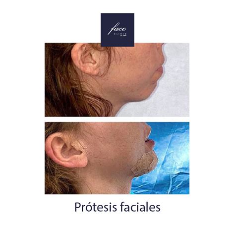 Implante De Menton Masculino Antes Y Despues