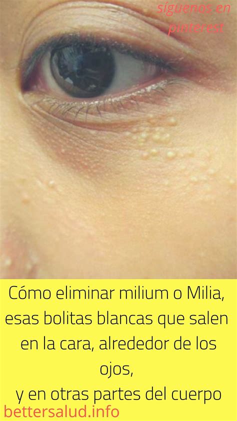 Cómo eliminar milium o Milia esas bolitas blancas que salen en la cara