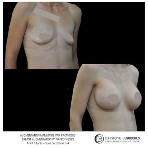 Augmentation mammaire par prothese Chirurgie esthétique Marseille
