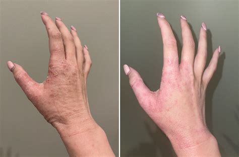 Eczema Skin Treatment Epidermis Sage Holistic Skincare Therapists