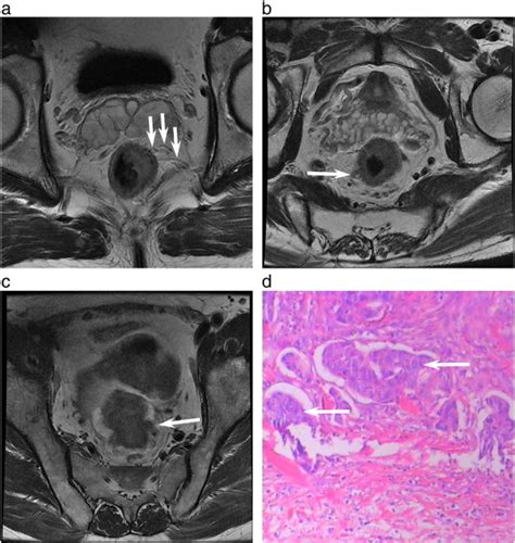 Correlation Of MRI Detected Extramural Vascular Invasion With Regional