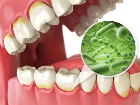 Placa Bacteriana Qu Es Y Como Prevenirla Cl Nica Dental Tacna