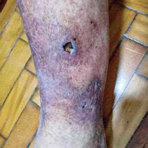 Uma ferida que não cicatrizava e o risco de amputação da perna