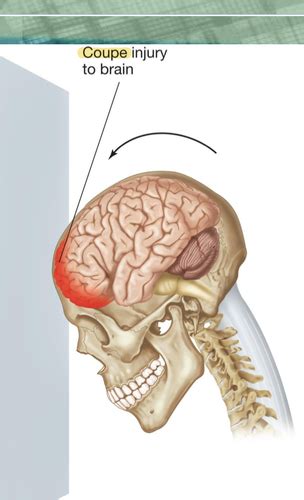 Ch Traumatic Brain Injury Flashcards Quizlet