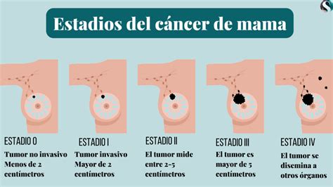 Guía sobre el cáncer de mama síntomas factores de riesgo pronóstico