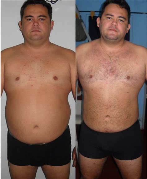 Imagens Antes E Depois Da Abdominoplastia