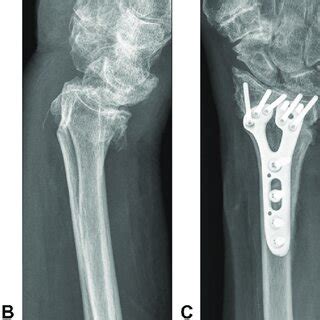 Preoperative A Anteroposterior And B Lateral Radiographs Showing Acute