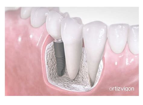 Regeneraci N Sea Dental Resolvemos Tus Dudas Cl Nica Ortiz Vig N