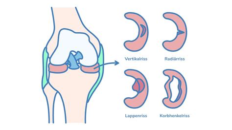 Meniskus Anatomie Und Funktion Orthopy