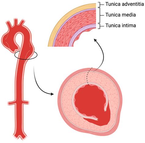 Life Free Full Text Current Understanding Of Aortic Dissection