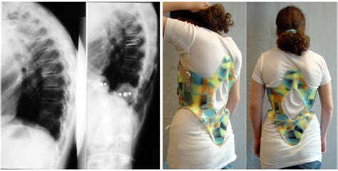 Brace Treatment For Patients With Scheuermann S Disease A Review Of