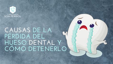 Causas de la pérdida de hueso dental y como detenerlo