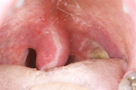 Swollen Uvula