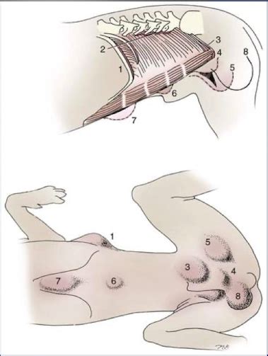 Name That Hernia Diagram Quizlet