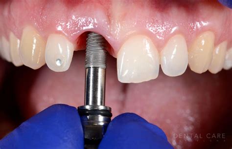 Causas De Rechazo Y Fracaso De Los Implantes Dentales Dental Care